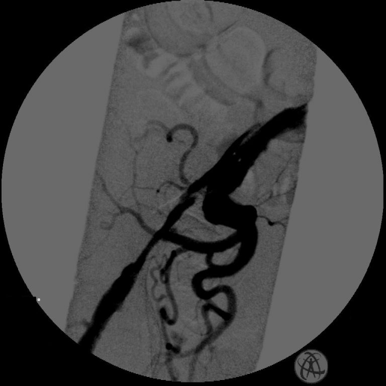 Complex EVAR - Infrarenal aortic aneurysm with occluded external iliac ...