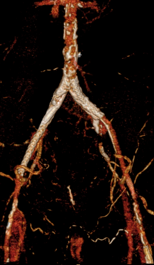 Complex transbrachial iliac and femoral revascularization - v a s c n o w